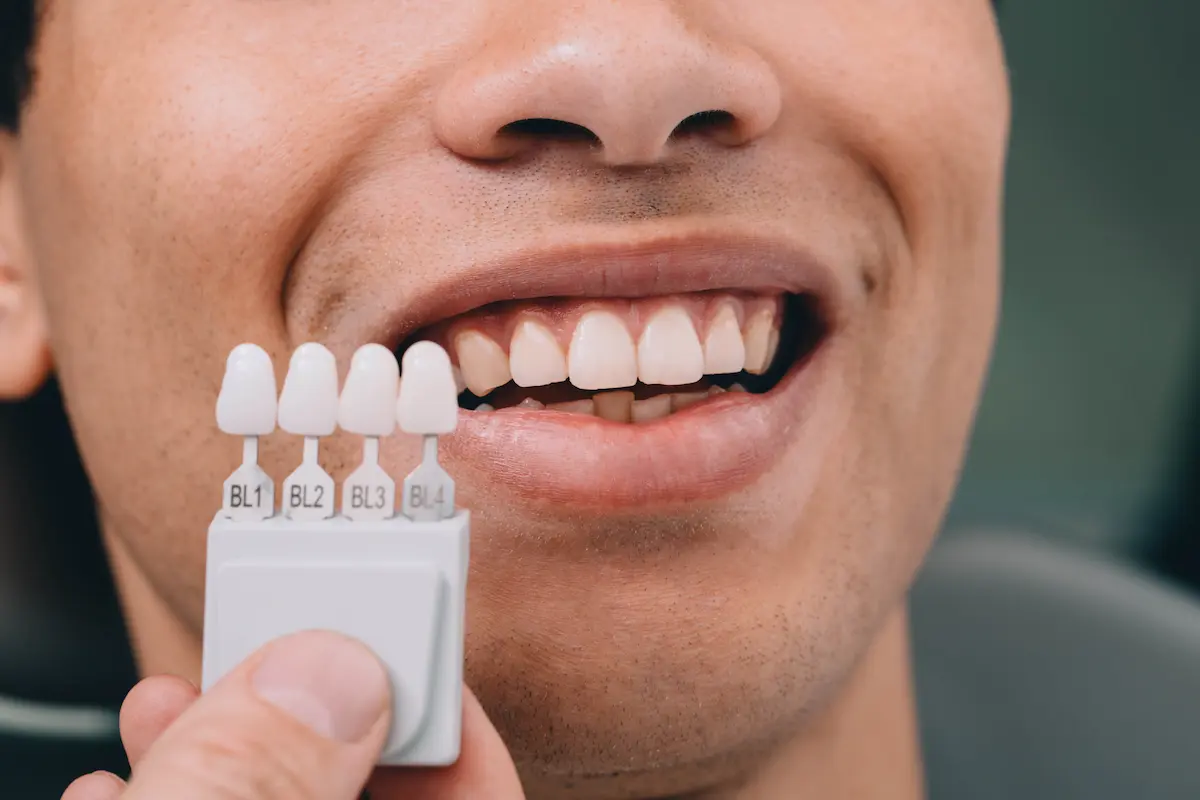 Veneers vs Crowns: Complete Comparison Guide to Choose the Right ...