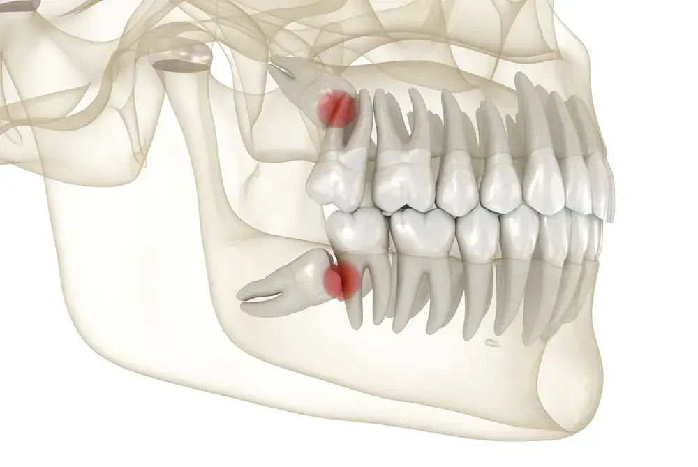 Wisdom Teeth Removal Langley | Dentist Langley | Spire Dental Care Langley